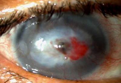 Ophthalmology 4 - Cornea - Further Complications