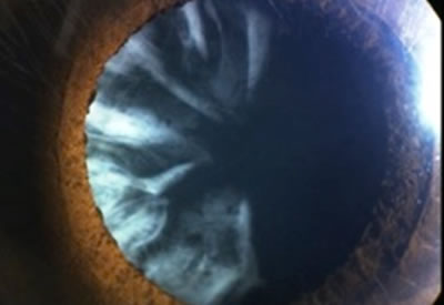 Ophthalmology 5 - Cataract - Management of Condition